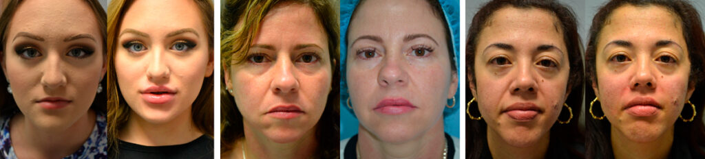 Facial Harmonization Duluth GA | Bella Forma
